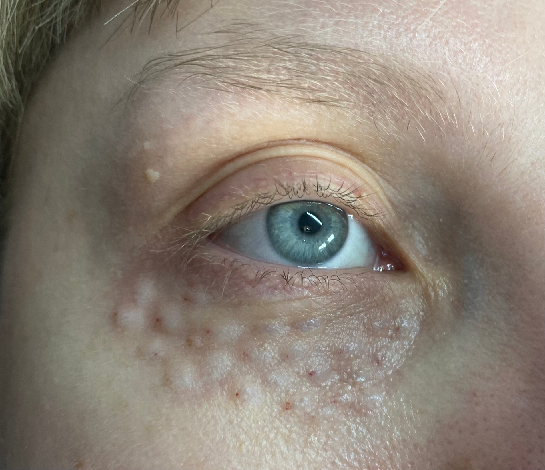 Polynucleotides- The game changer for under eye problems – facesbydrfrances